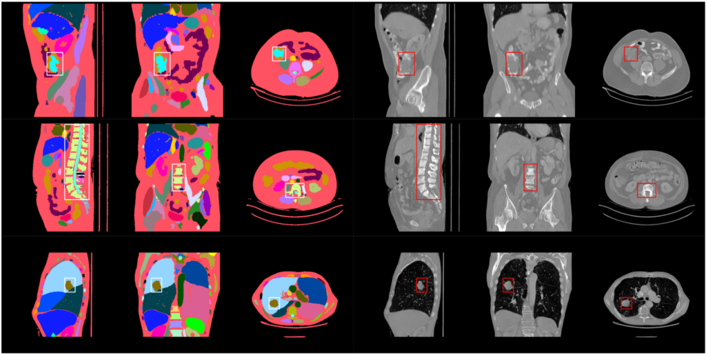 Addressing Medical Imaging Limitations with Synthetic Data Generation | NVIDIA Technical Blog